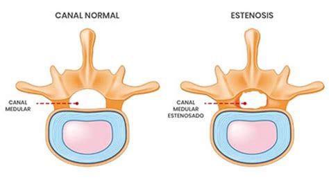 Estenosis De Canal Lumbar