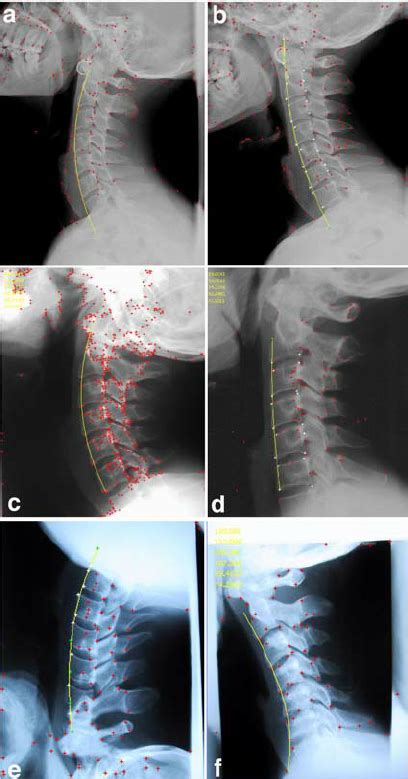 Angular Variation Between The Positions Of Extension And Flexion Using Download Scientific
