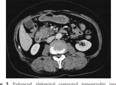 Figure 1 From A Case Of Choledochocele Associated With Acute