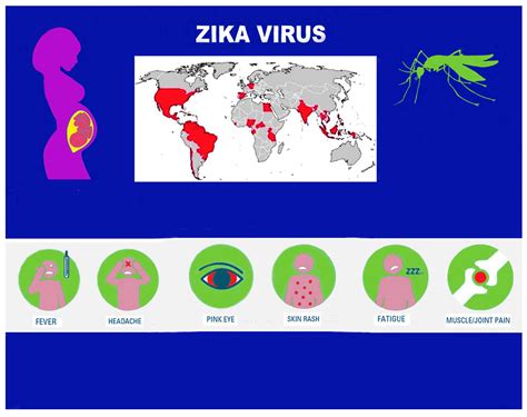 Congenital Zika Virus Syndrome Microcephaly And Orofacial Anomalies