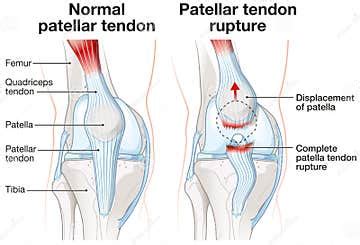 Patellar Tendon Rupture Knee Injury Sports Injury Knee Pain Front