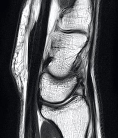 Scapholunate Instability An Update Radsource