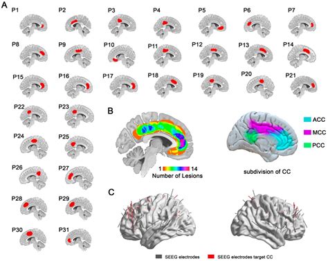 Electroclinical Features And Surgical Outcome Of Cingulate Epilepsy