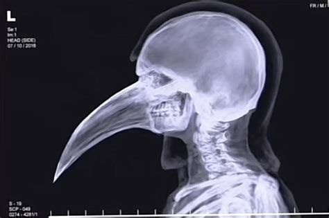 X Ray Of Scp 049s Head Rscp