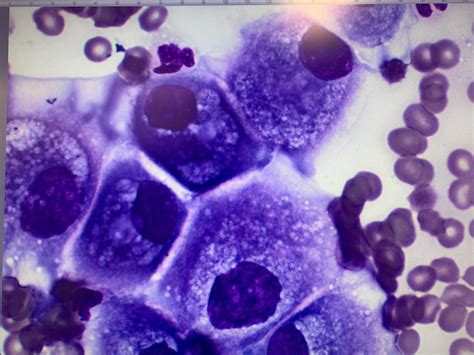 How To Differentiate Normal Mesothelial Cells Vs Carcinoma R