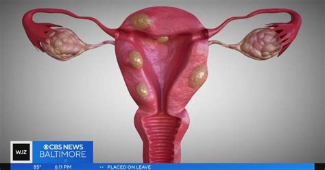 Hidden Health Dangers Uterine Fibroids A Common Tumor Among Women Cbs Baltimore