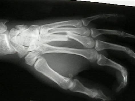 Operative Treatment Of Metacarpal Shaft Frx Wheeless Textbook Of Orthopaedics