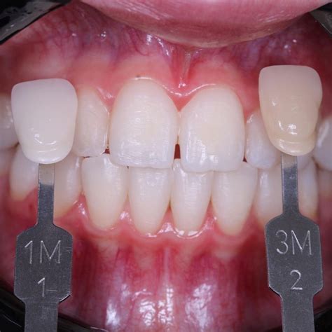 Dental Bleaching The Science Based Techniques For Every Day — Explore Dentistry
