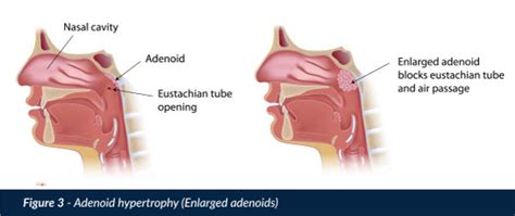 Snoring Or Sleep Apnoea Treatment Singapore Dr Gan Ent Specialist
