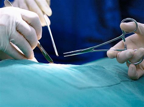 Fundoplication Uses What To Expect And More