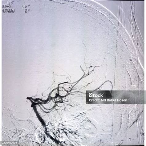 Digital Subtraction Angiography Or Cerebral Angiography Of Brain