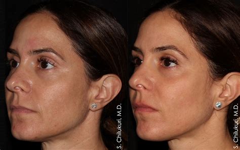 Ipl Bbl Hero Cynosure Icon Lummeca 10 Refresh Dermatology