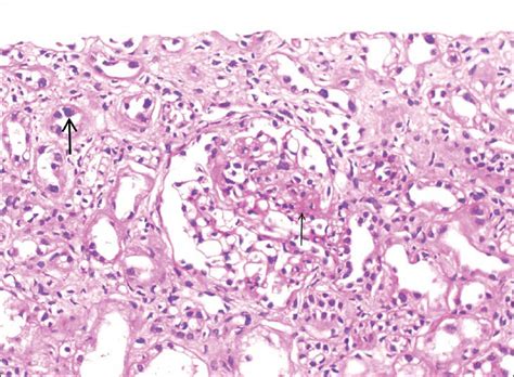 Karyomegalic Interstitial Nephritis With Focal Segmental
