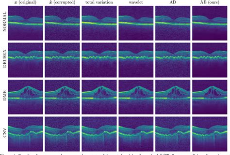 Semantic Denoising Autoencoders For Retinal Optical Coherence Tomography