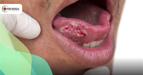 Tongue Cancer Early Signs