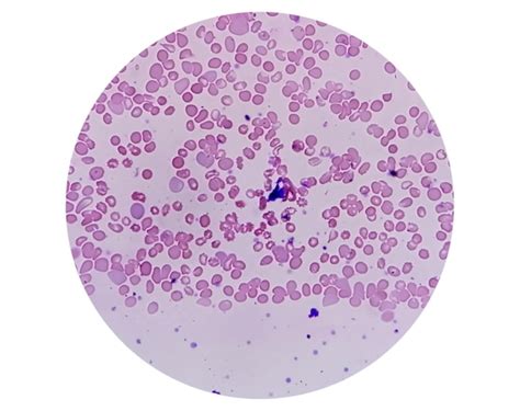 Pancytopenia Images Free Download On Freepik