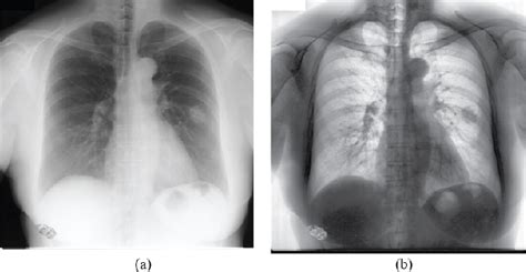 Figure 2 From Detection Of Lung Nodules In Chest Radiographs Using Wiener Filter And D Cnn Model