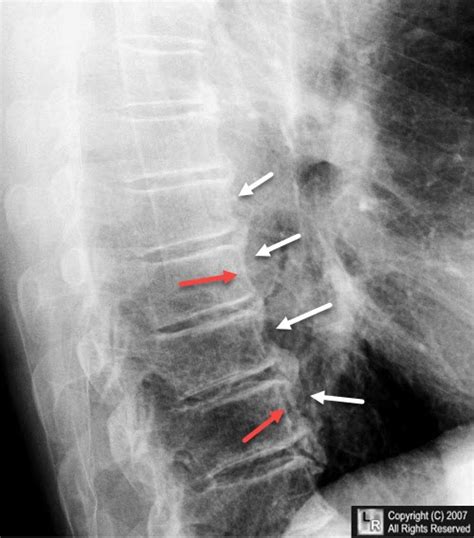 Learningradiology Diffuse Idiopathic Skeletal Hyperostosis Dish