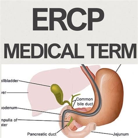 Ercp Medical Abbreviation Analgesia