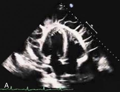 Introduction To Clinical Echocardiography Pericardial Disease