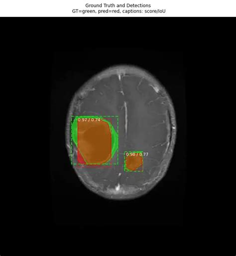 Github Ilhansevval Mask R Cnn Brain Tumor Segmentation This Repository Gives Information How