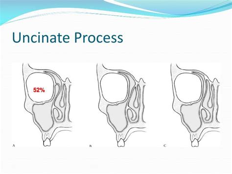 Ppt Principles Of Functional Endoscopic Sinus Surgery Powerpoint