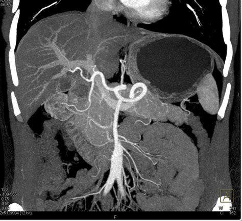 Gist Duodenum Small Bowel Radiology Case Studies Ctisus Ct Scanning Gist Duodenum Small Bowel Radiology Case Studies Ctisus Ct Scanning