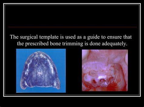 100121562 Immediate Dentures Ppt Autosaved Ppt Free Download