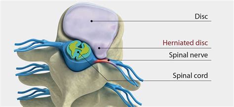 Herniated Disk New Technique Both Refills And Patches Herniated Discs