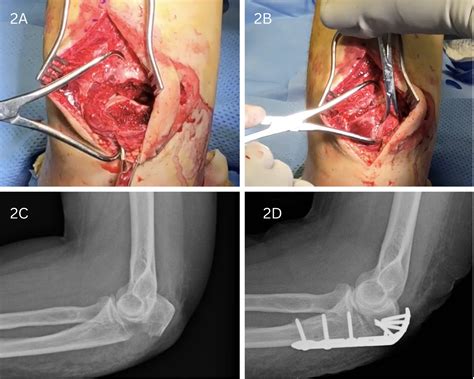 Olecranon Fracture Fixation Surgical Technique Published In Surgicoll