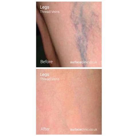 Thread Veins Surface Clinic