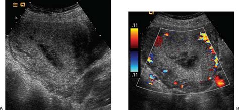 Postpartum Complications Radiology Key
