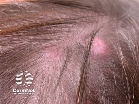 Pilar Cyst Trichilemmal Cyst