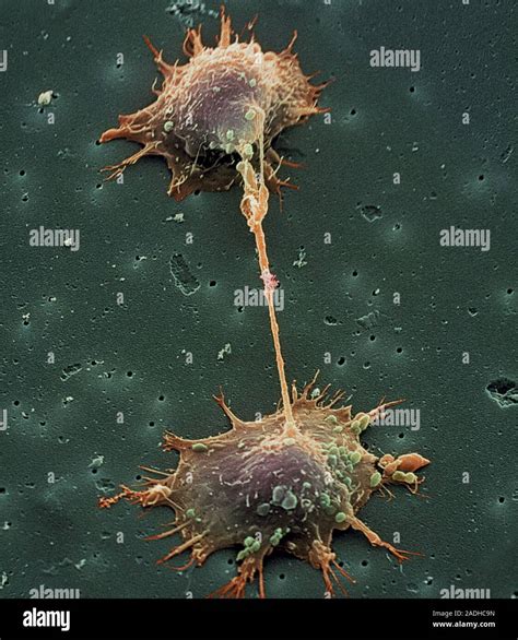 Prostate Cancer Cell Division Coloured Scanning Electron Micrograph Sem Of Two Prostate