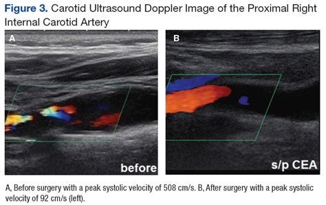 Hypoperfusion Retinopathy Mdedge