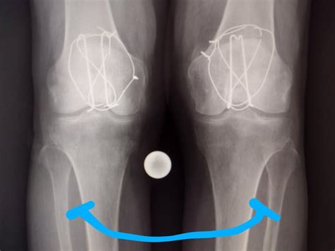My Spinal Fusion Before And After Rxrayporn
