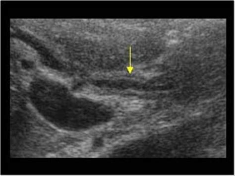 Cholangitis Inflammation Of Bile Duct Walls Greater Than 5mm Biliary… Medical Ultrasound