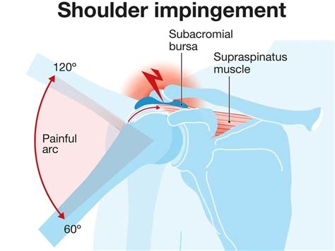 Shoulder Impingement Syndrome My Sports Chiropractor