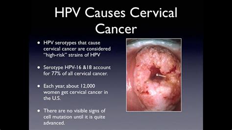 Hpv Presentationmov Youtube