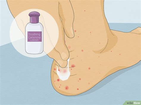 How To Treat Sand Flea Bites Soothe Itchy Irritated Skin Fast