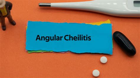 Angular Cheilitis Everything You Need To Know Healthkart