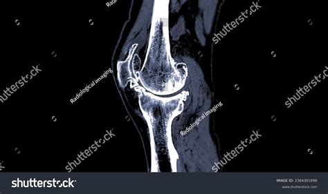Ct Knee Or Ct Scan Image Of Knee Joint Sagittal Royalty Free Stock