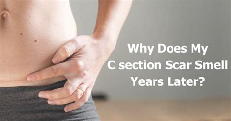 Why Does My C Section Scar Smell Years Later And How To Fix It