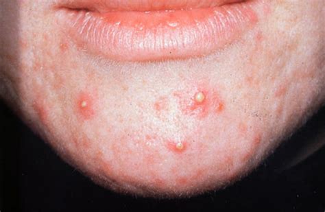 Acne Care Day By Day Beauty