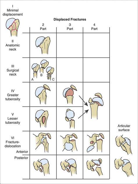 Management Of Acute Proximal Humeral Fractures Jaaos Journal Of The