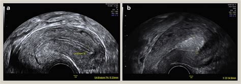 Ultrasound In Obstetrics And Gynaecology Obstetrics Gynaecology And