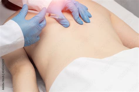 Doctor Injects Trigger Points On The Patient S Back To Eliminate Muscle Spasm And Pain Lumbago