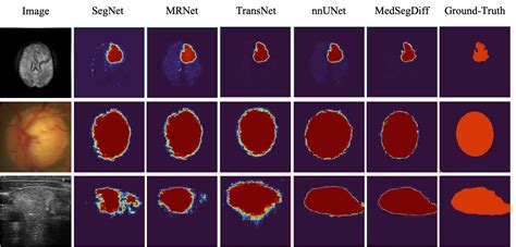MedSegDiff Medical Image Segmentation With Diffusion Probabilistic Model
