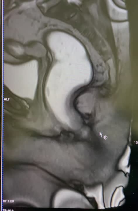 Atif Zaffer On Linkedin Mr Defecogram History Perianal Pain During