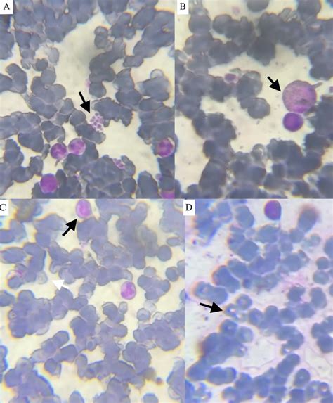 Plasmodium Vivax Thick Smear